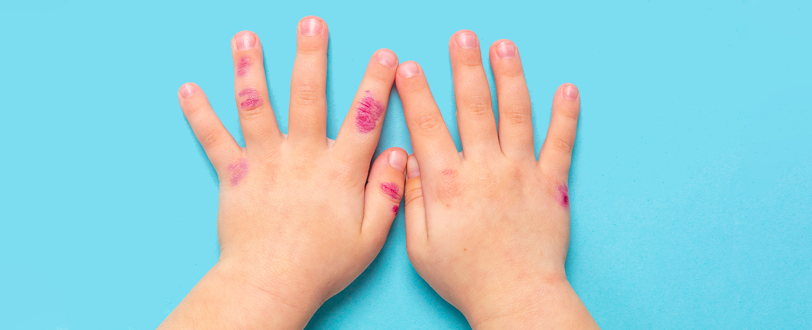 Psoriasi nei bambini – Ceramol